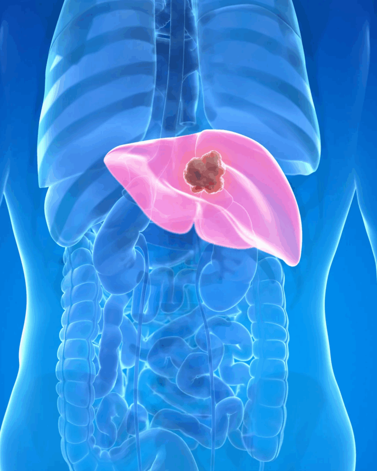 ARE LIVER CYSTS ACTUALLY PARASITES? ~ HealthPrimitive